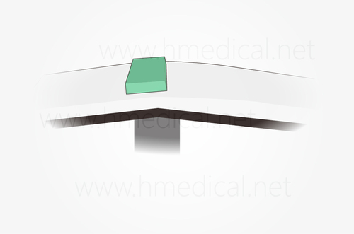 髋关节前侧入路（DAA）的手术图解 - 广州绘美医学科技有限公司